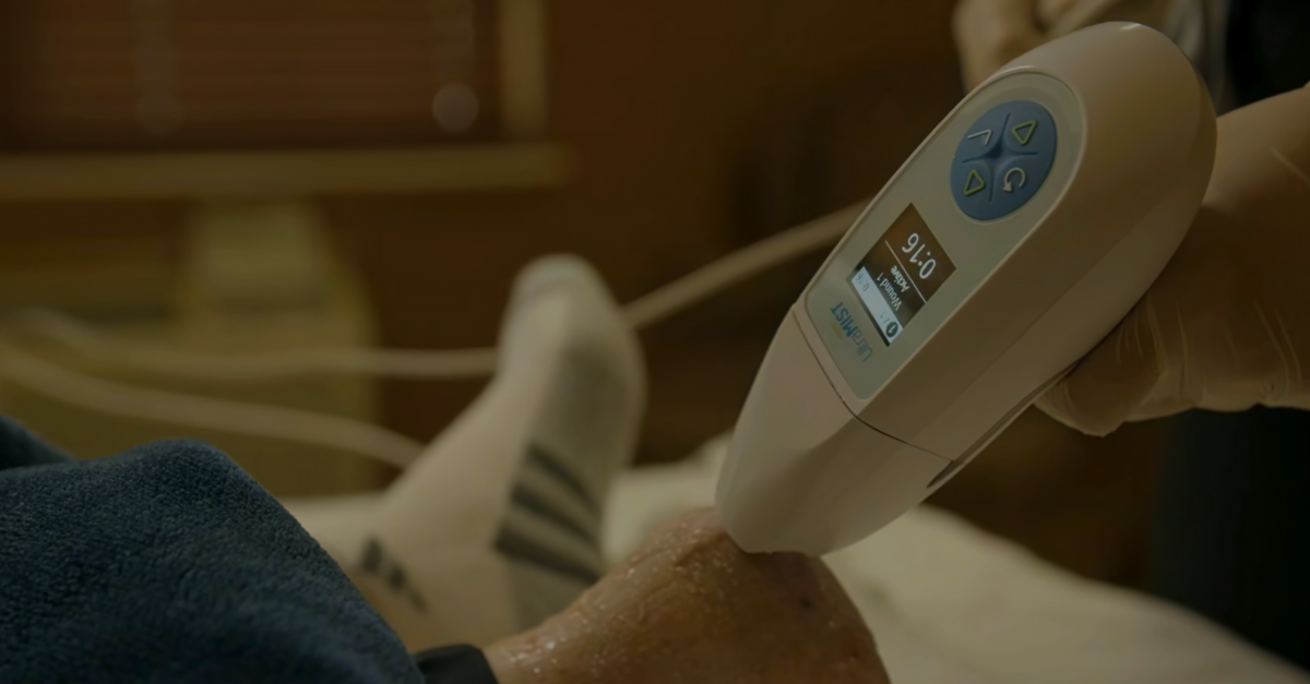 Sanuwave UltraMIST® Therapy: A Clinically Proven, Non-Contact Approach ...